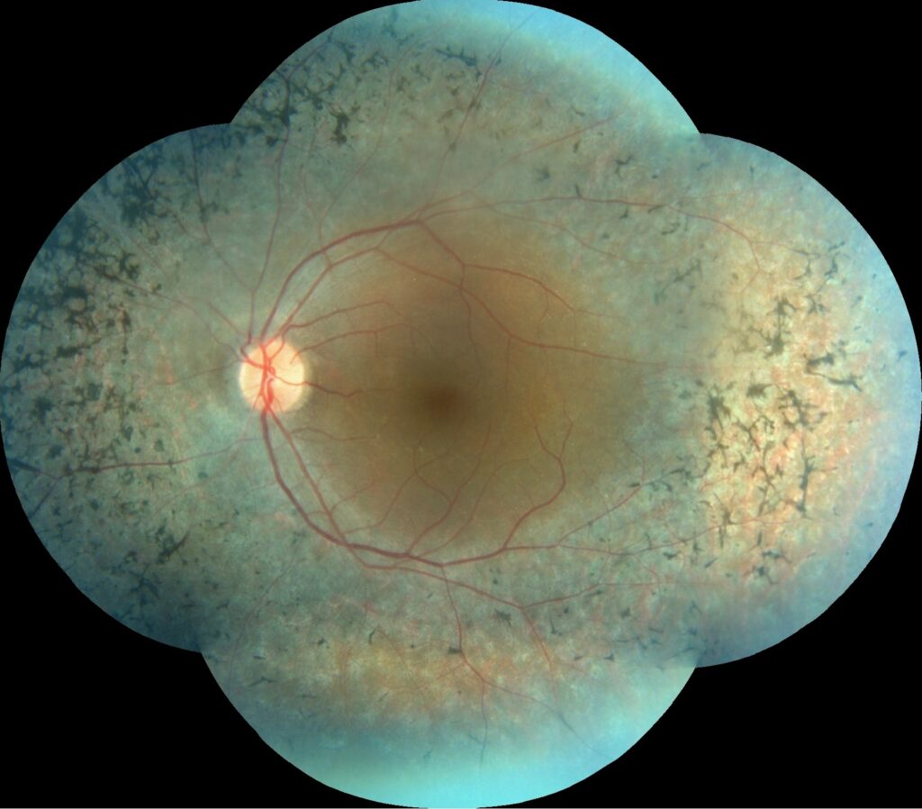 Retinitis Pigmentosa-Associated Cystoid Macular Edema - RetinaRA