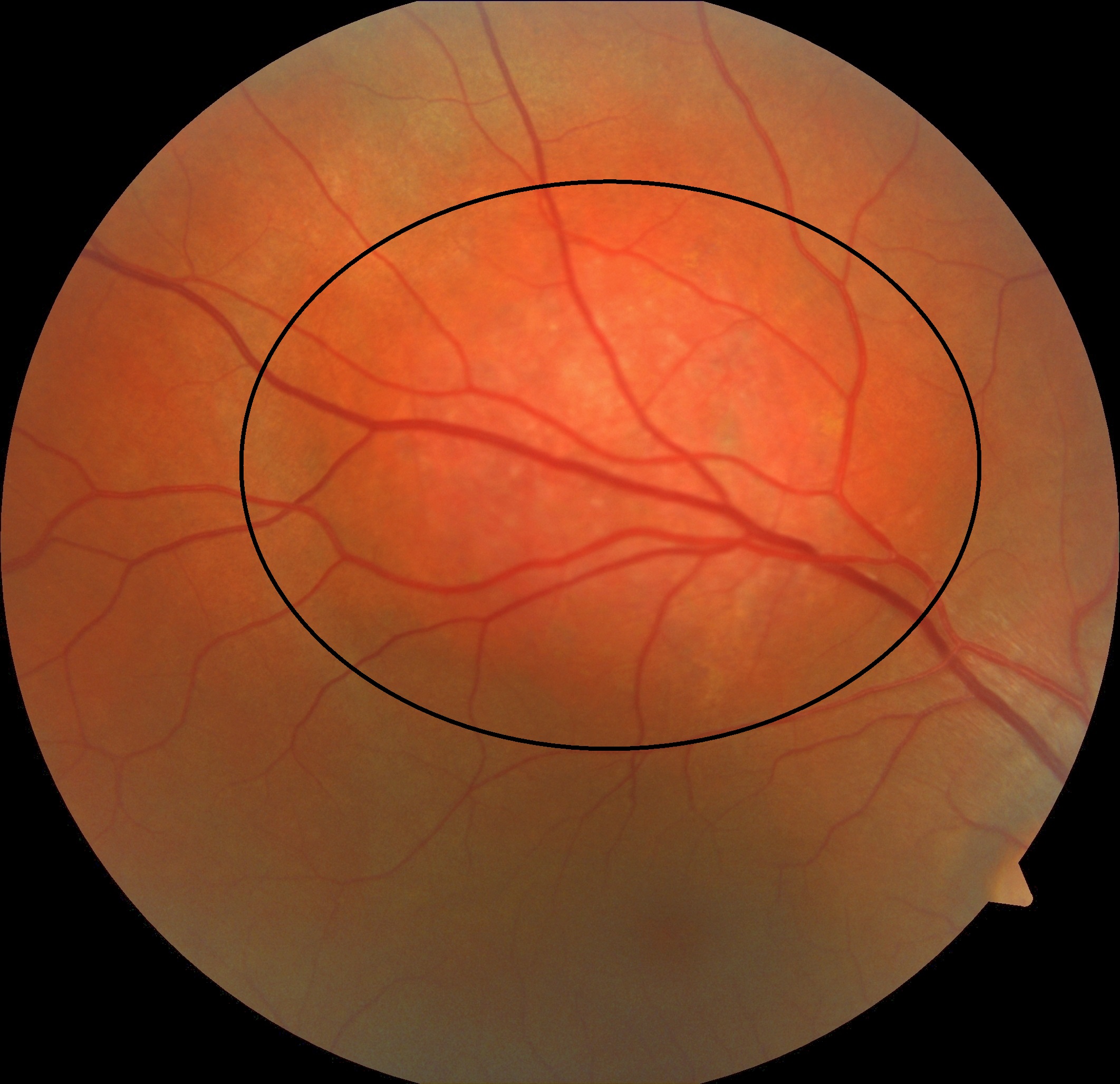 Circumscribed Choroidal Hemangioma Treated with Bolus Protocol PDT
