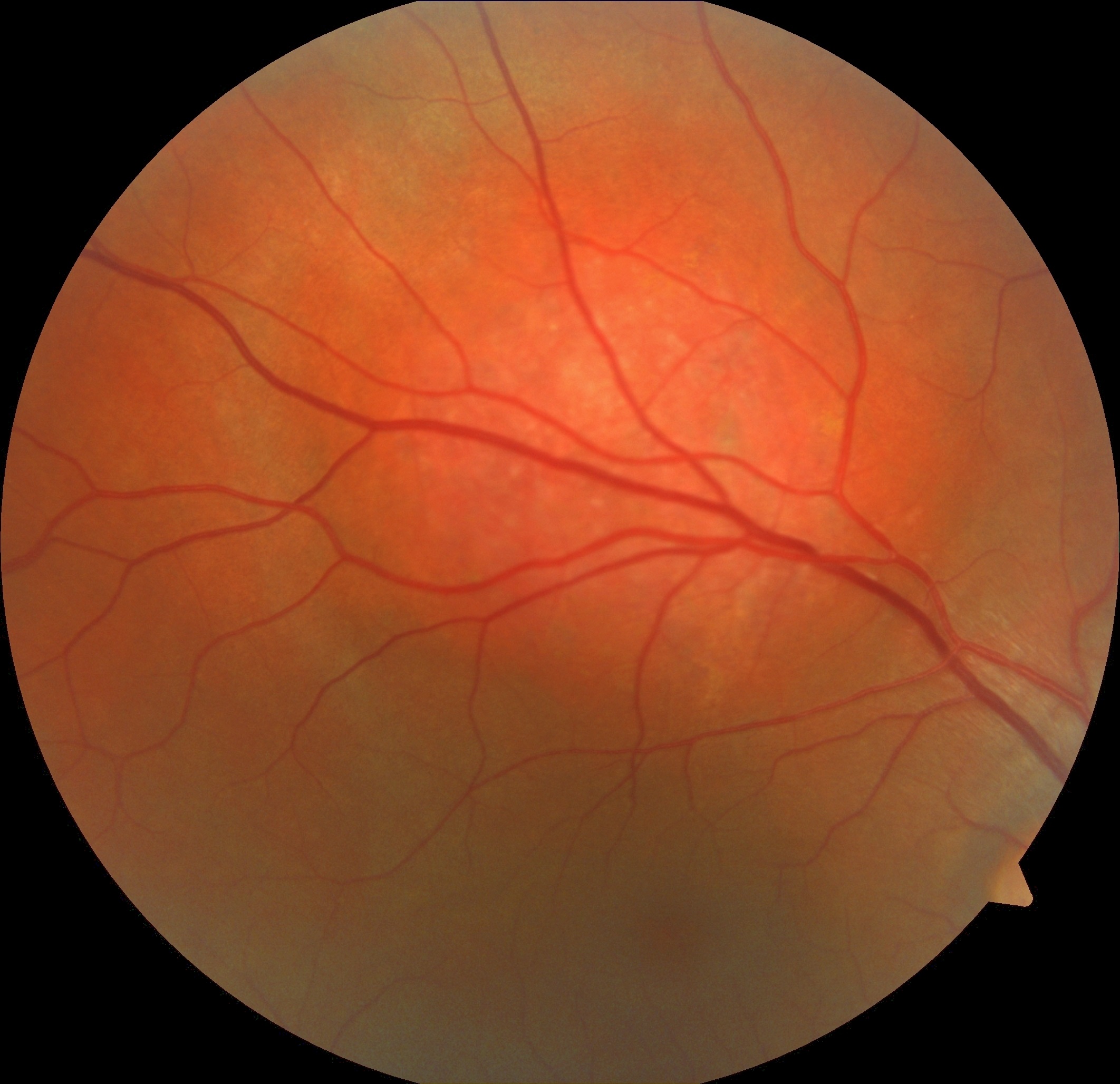 Circumscribed Choroidal Hemangioma Treated with Bolus Protocol PDT