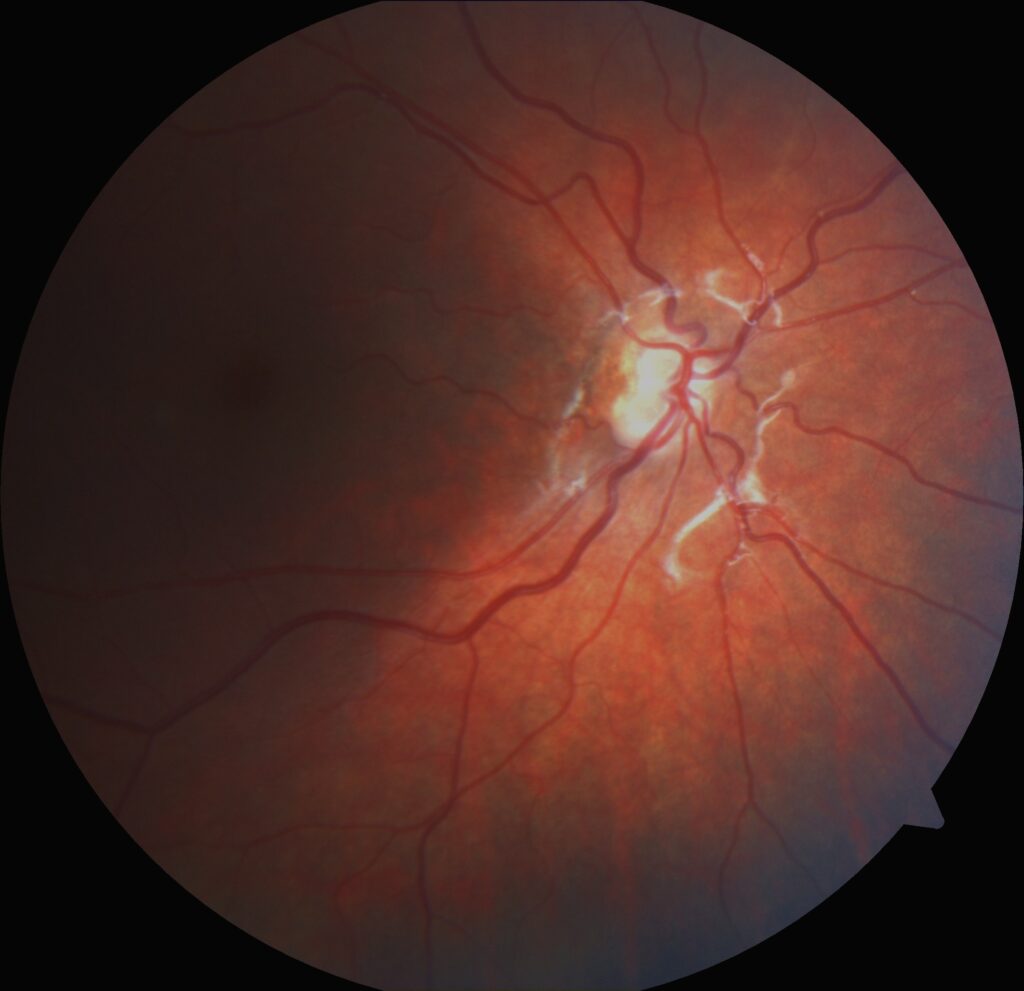 Optic Nerve Hypoplasia - RetinaRA