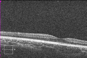Optic Nerve Hypoplasia - RetinaRA