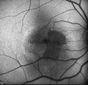 Retina Pigment Epithelial Tear - RetinaRA