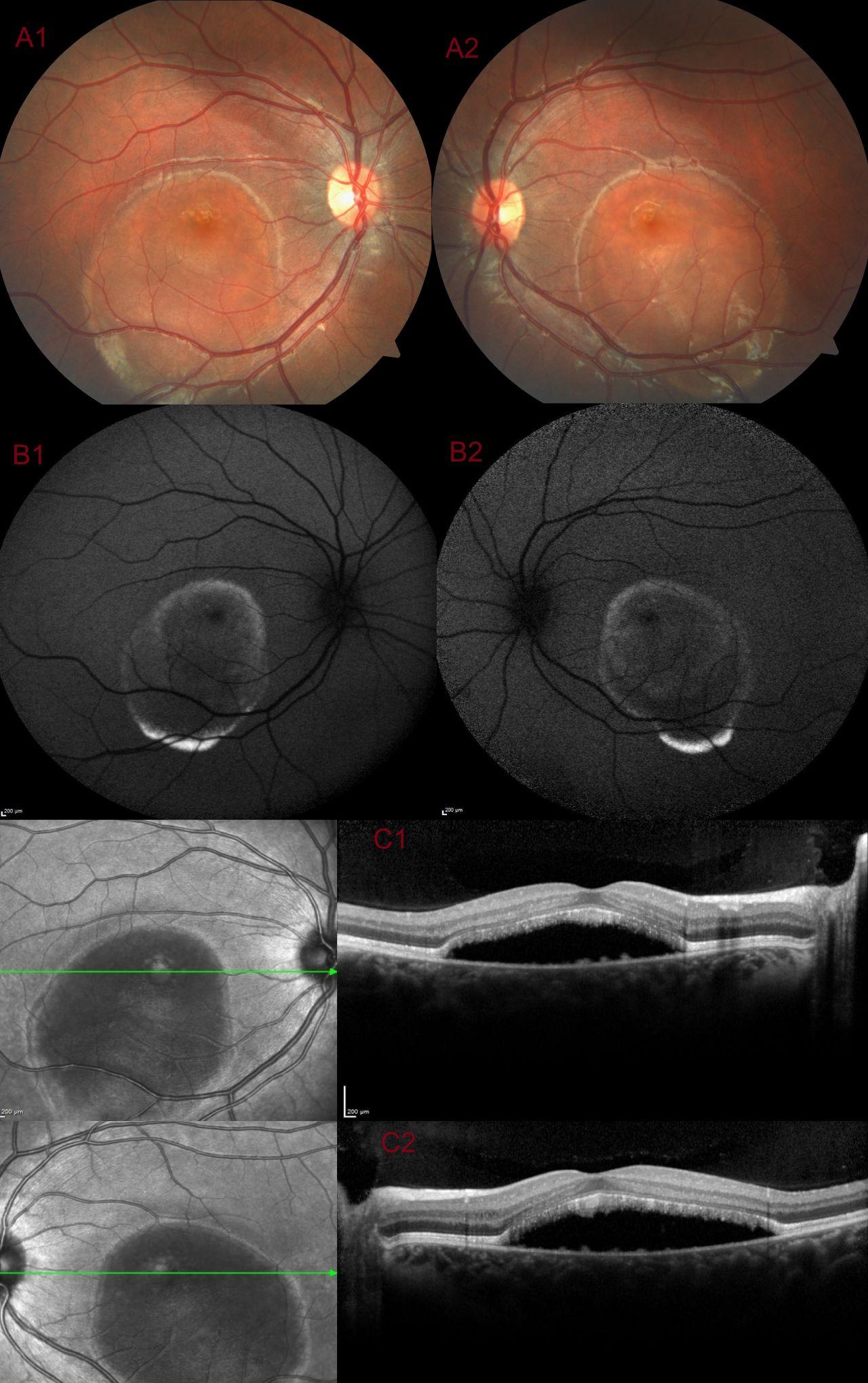 SEROUS MACULAR DETACHMENT IN BEST DISEASE - RetinaRA