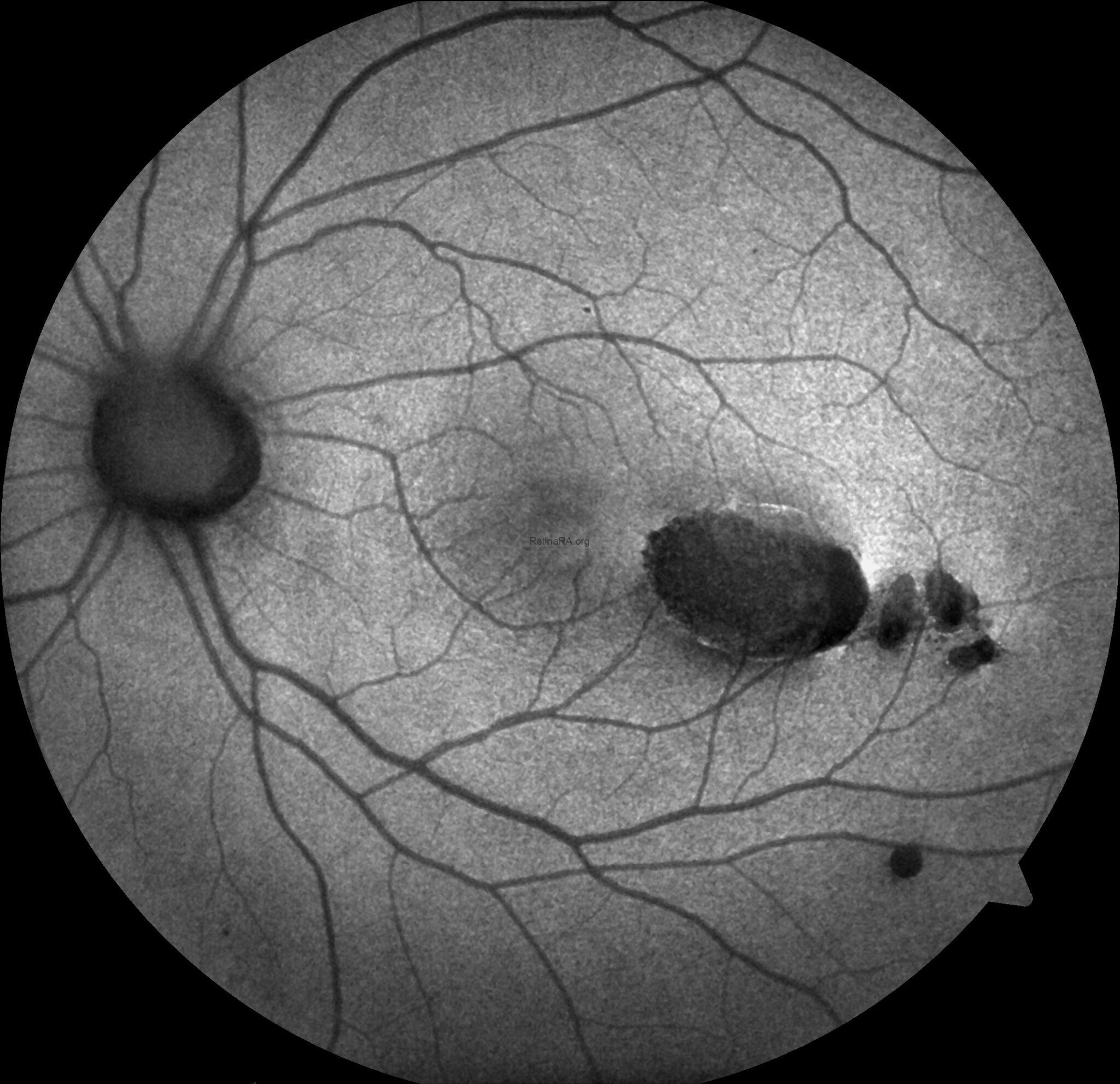 Torpedo Maculopathy - RetinaRA