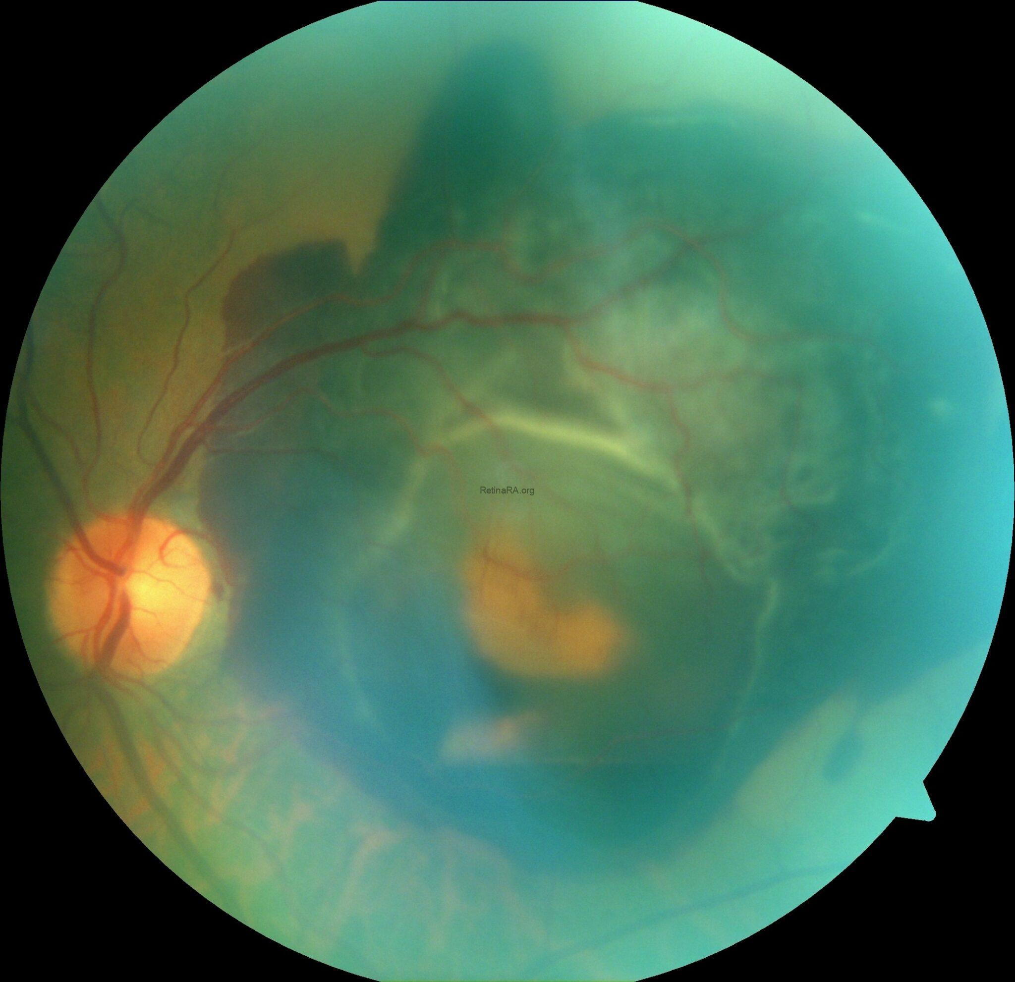 Type 1 Macular Neovascularization Complicated with RPE Tear and ...
