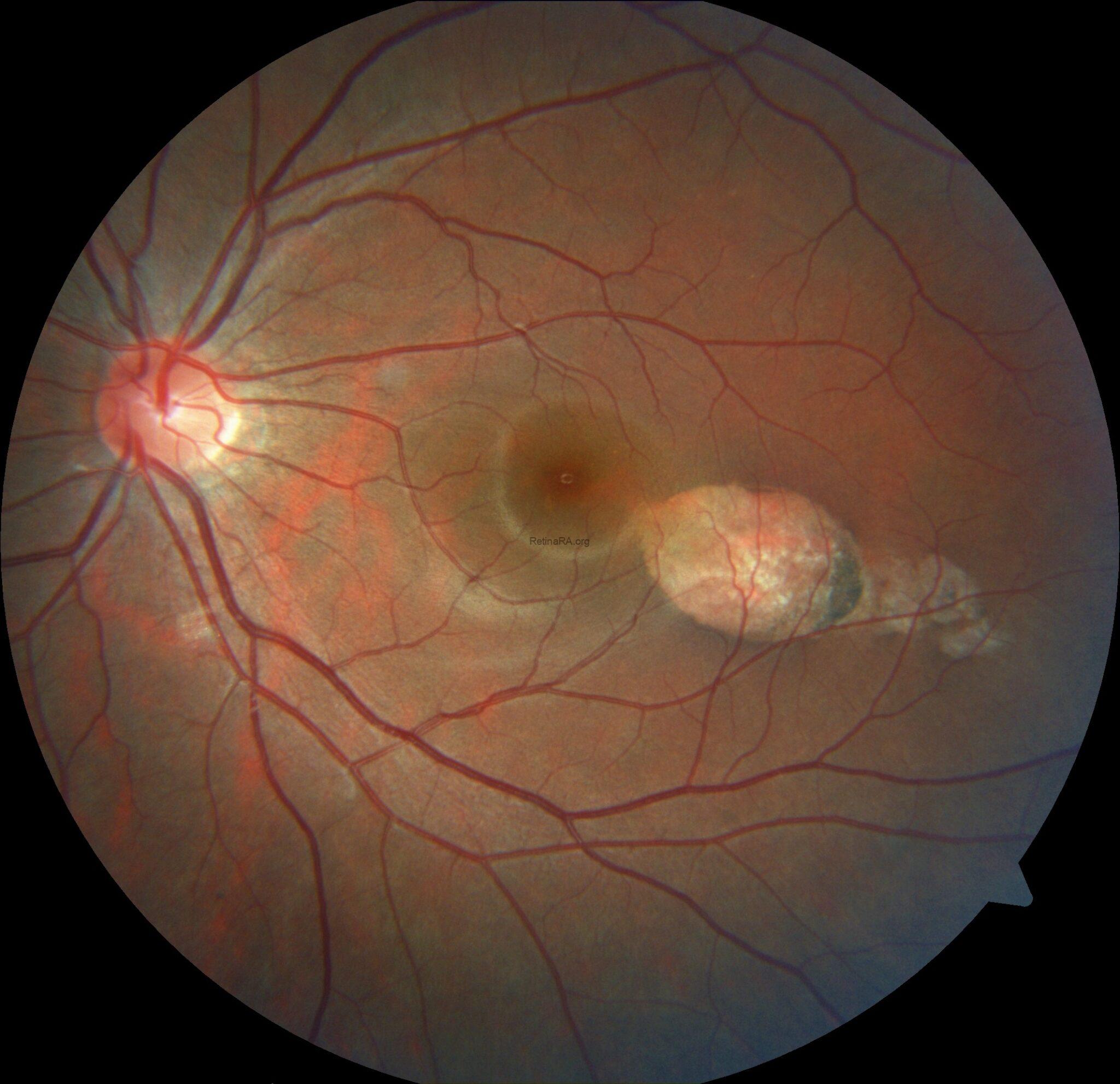 Torpedo Maculopathy Retinara