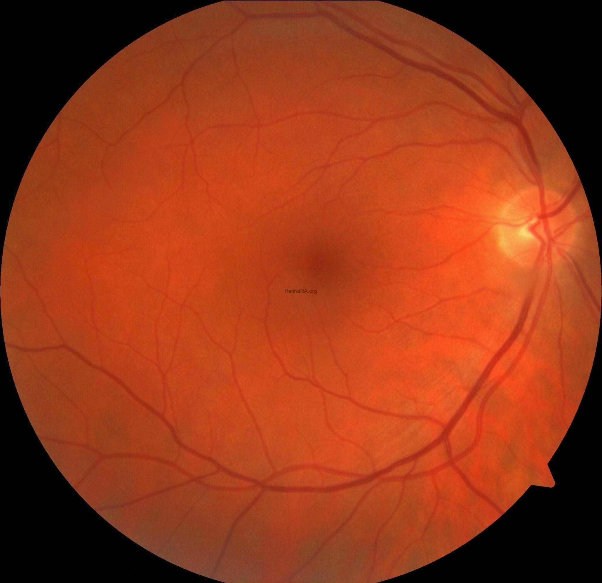 Non-ischemic CRVO + PAMM + P-MLM Sign - RetinaRA