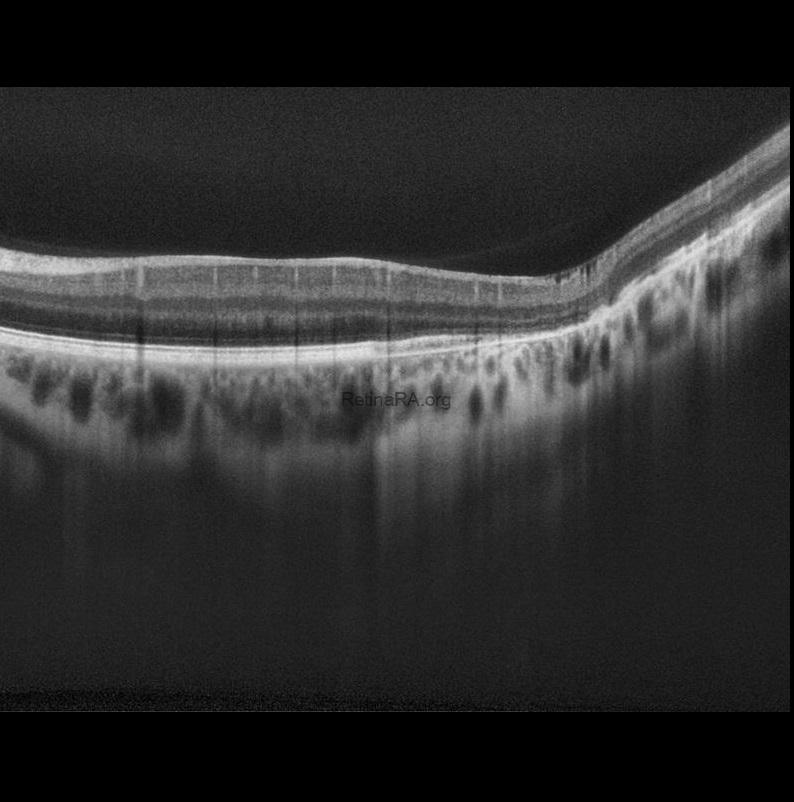 Torpedo Maculopathy - RetinaRA