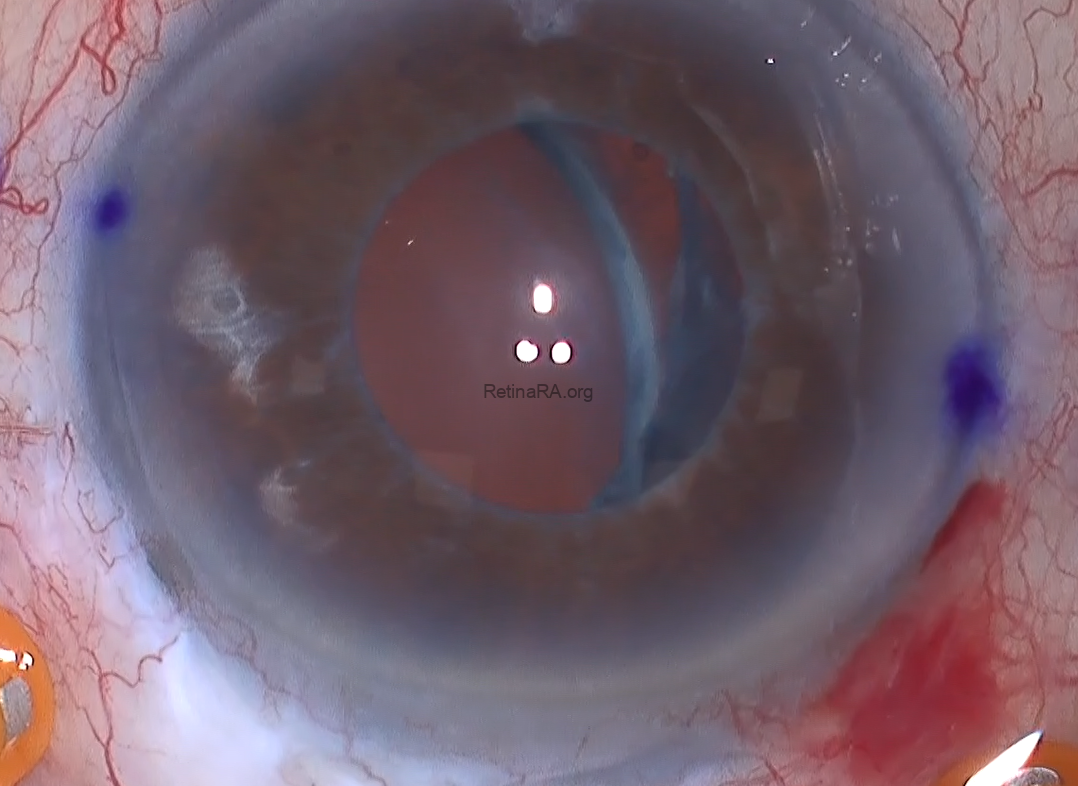 Yamane Intrascleral Haptic Fixation Technique From A Vitreoretinal ...