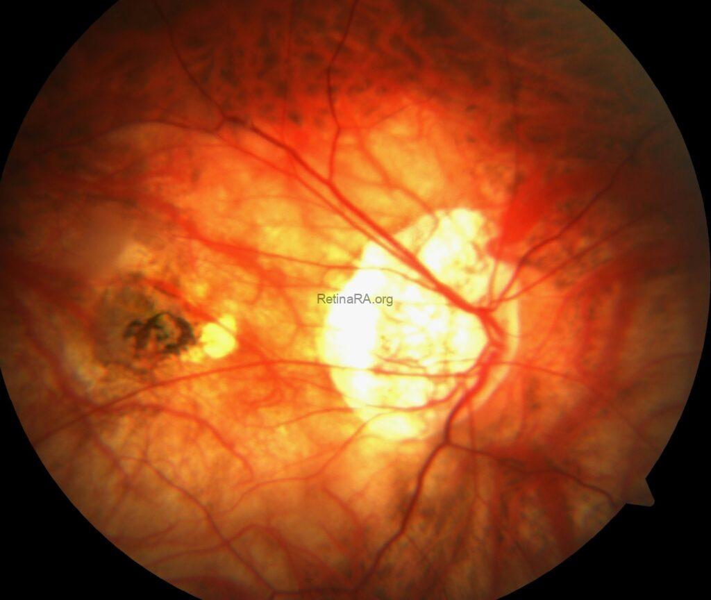 Peripapillary Intrachoroidal Cavitation - RetinaRA