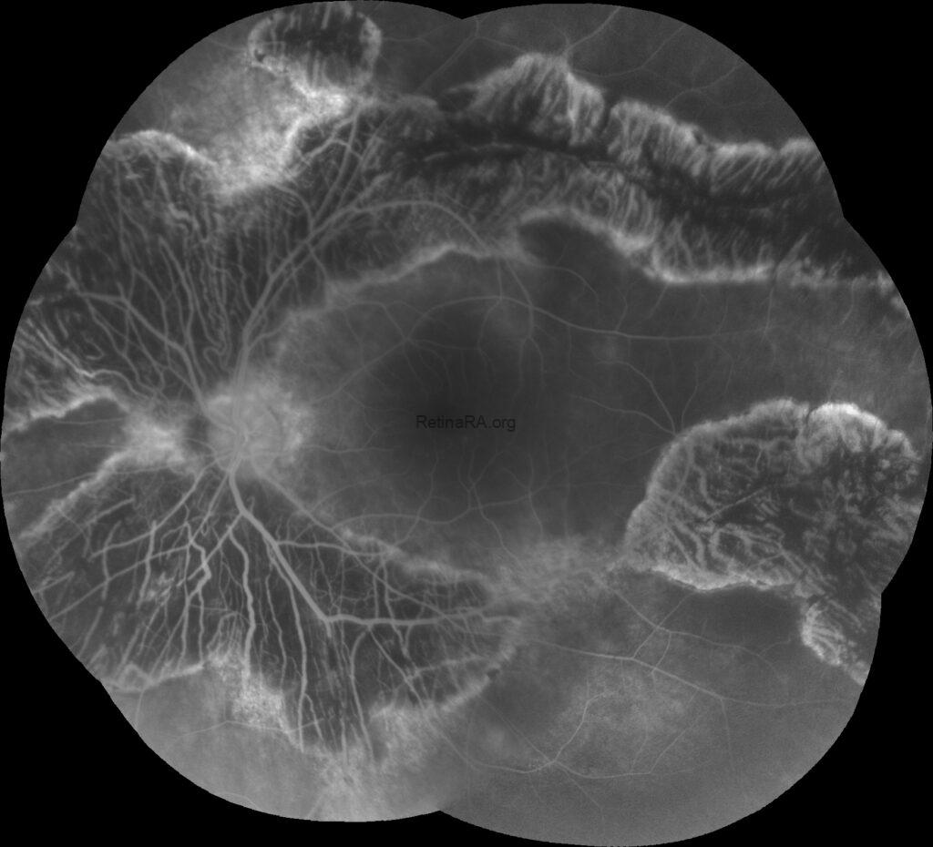 Pigmented Paravenous Retinochoroidal Atrophy - RetinaRA