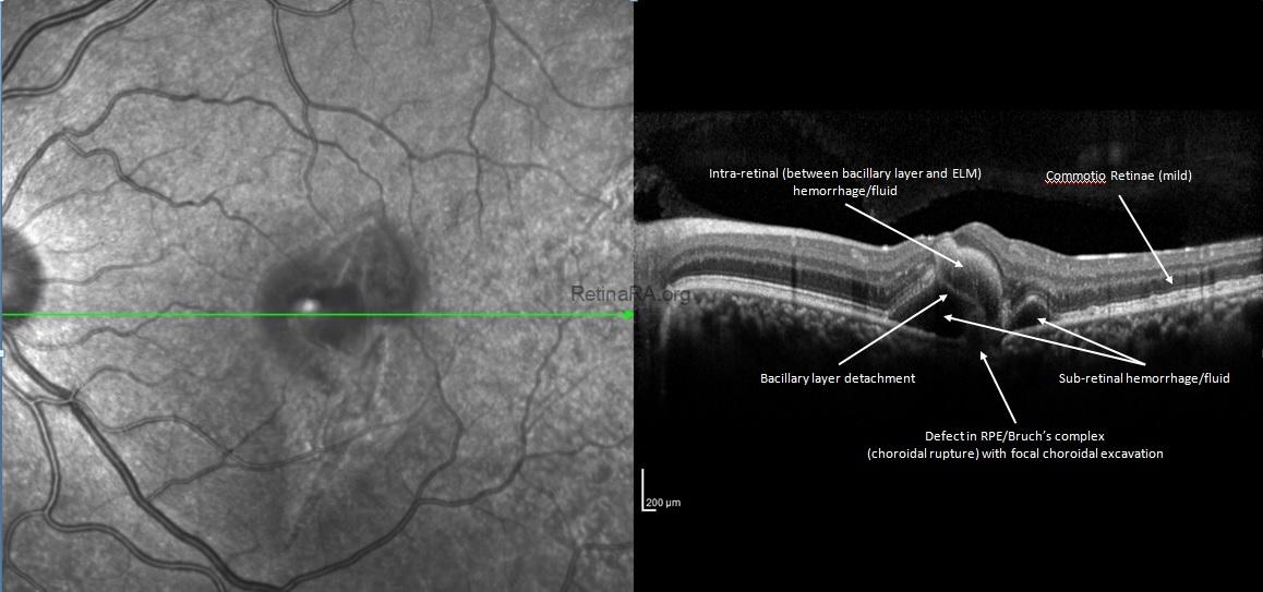 Bacillary Layer Detachment After Blunt Eye Trauma - RetinaRA