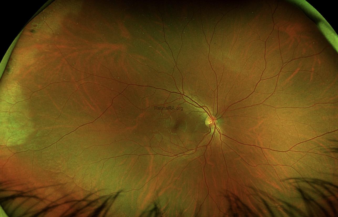 Lattice degeneration with retinal holes and WWOP - RetinaRA