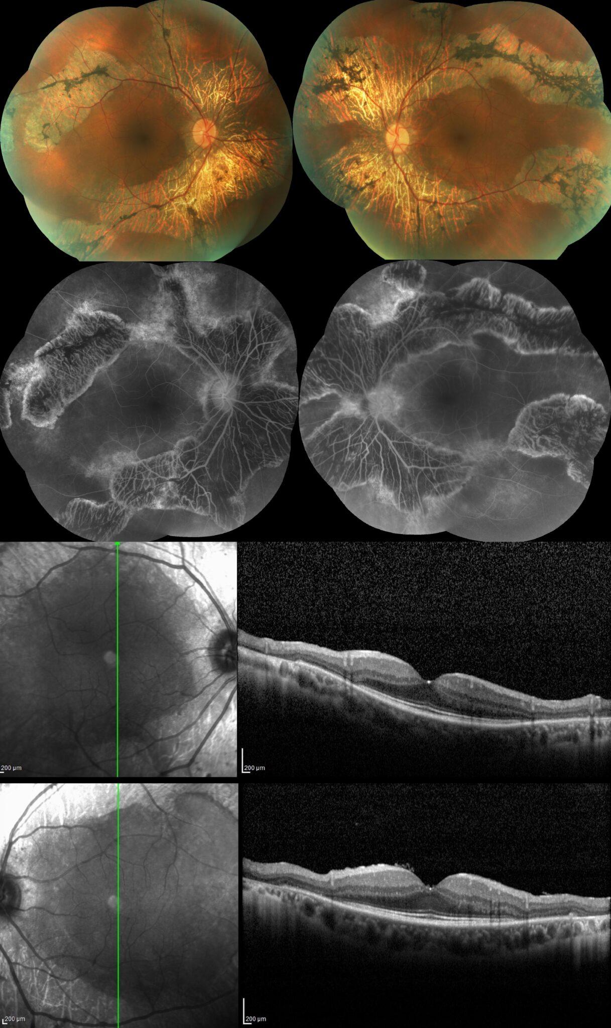 Pigmented Paravenous Retinochoroidal Atrophy - RetinaRA