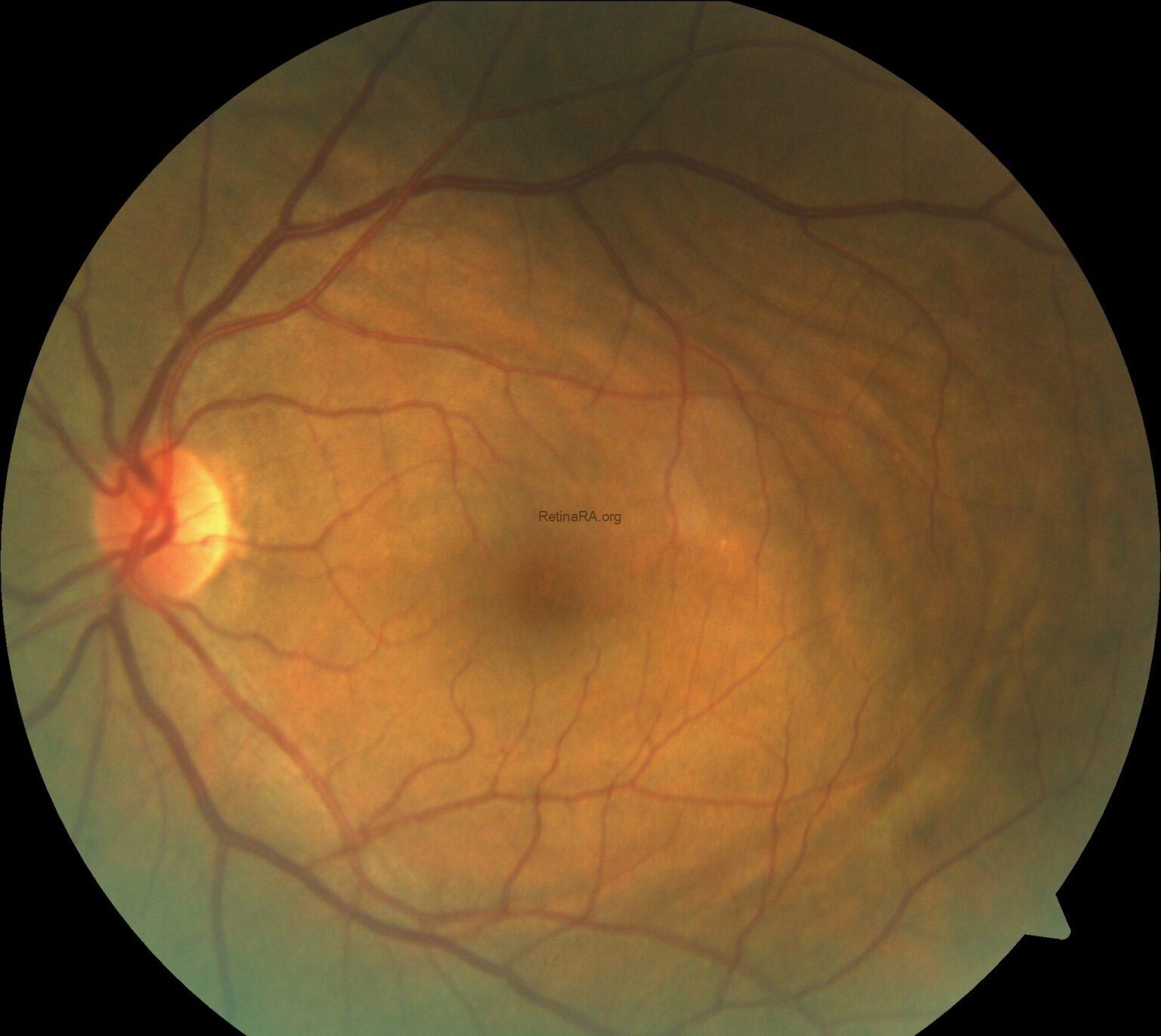 Idiopathic Choroidal Folds - RetinaRA