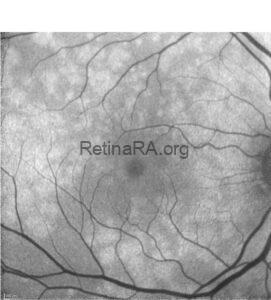 Multiple Evanescent White Dot Syndrome (MEWDS) - RetinaRA