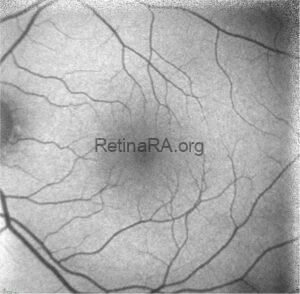 Multiple Evanescent White Dot Syndrome (MEWDS) - RetinaRA