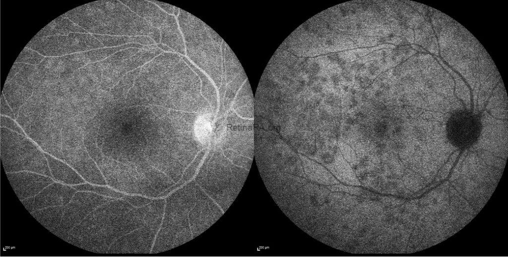 Multiple Evanescent White Dot Syndrome (MEWDS) - RetinaRA