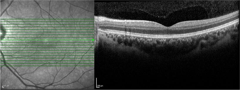 Multiple Evanescent White Dot Syndrome (MEWDS) - RetinaRA