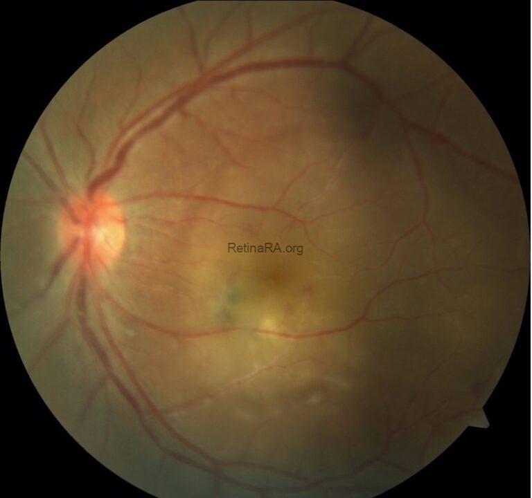 Ocular Toxoplasmosis with Serous Retinal Detachment - RetinaRA