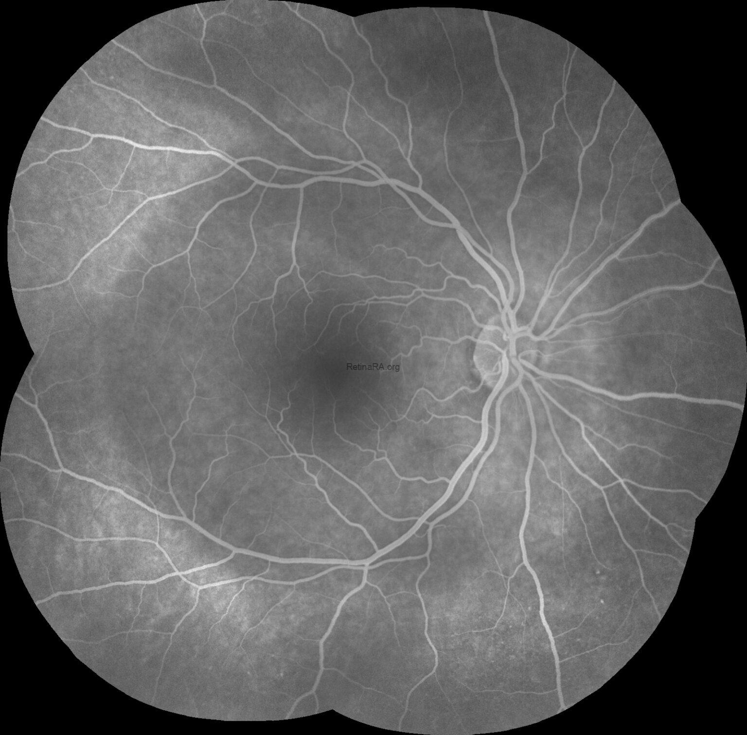 Henle Fiber Layer Hemorrhage Associated with Chronic Angle Closure ...