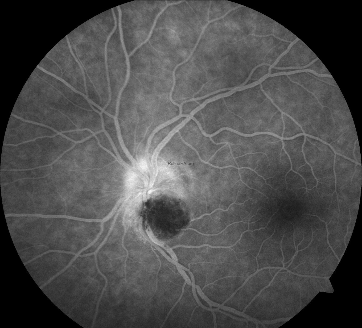 Optic Disc Melanocytoma - RetinaRA