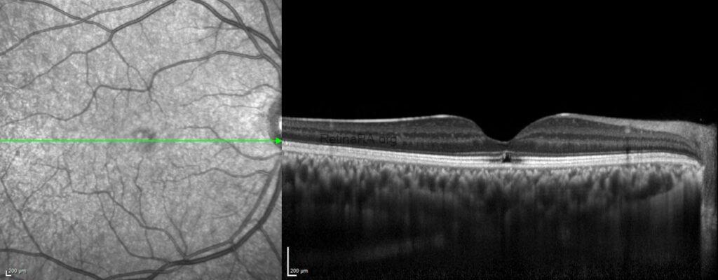 Solar Retinopathy - RetinaRA