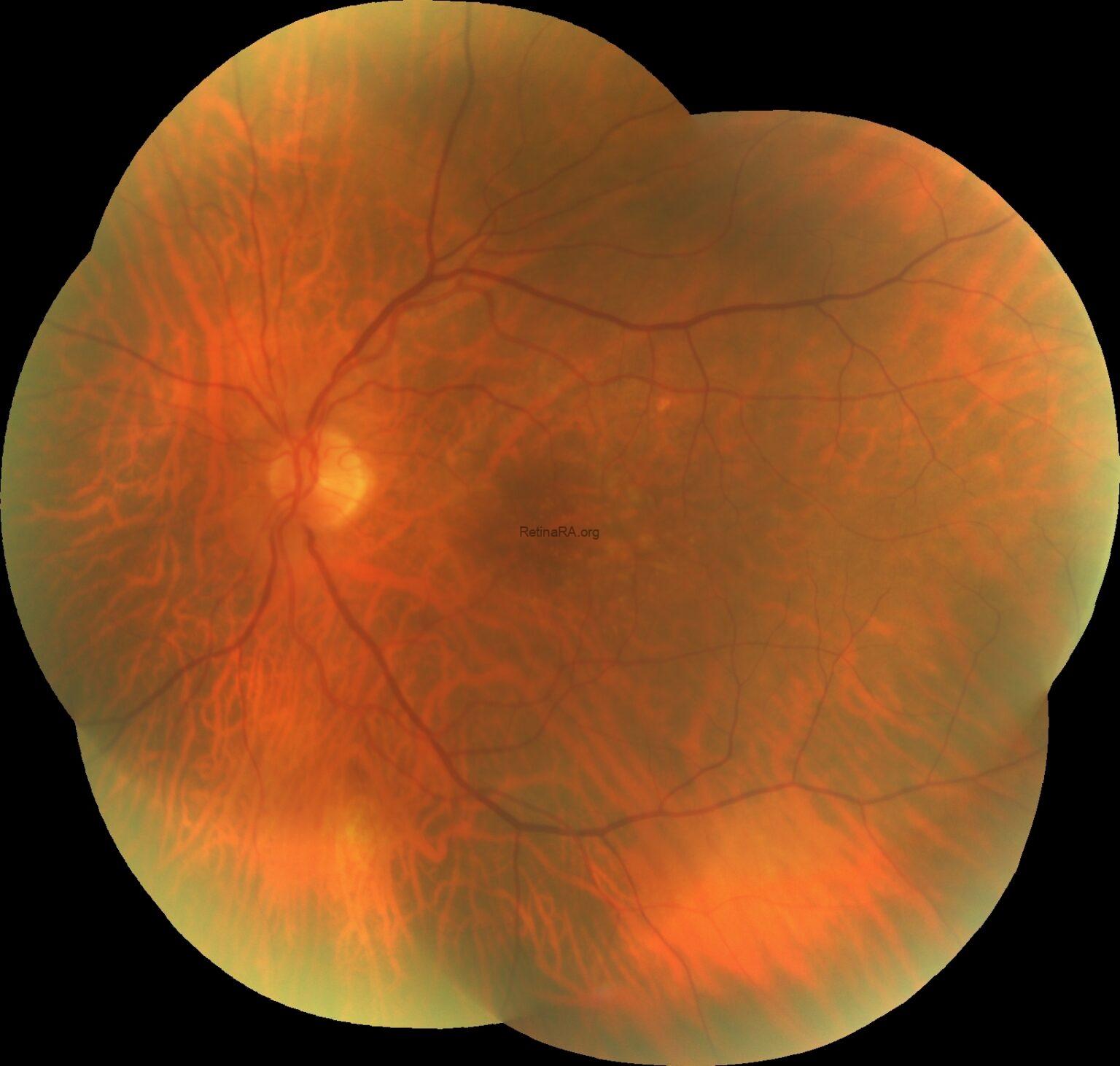 Irvine-Gass Syndrome (Pseudophakic cystoid macular edema) - RetinaRA