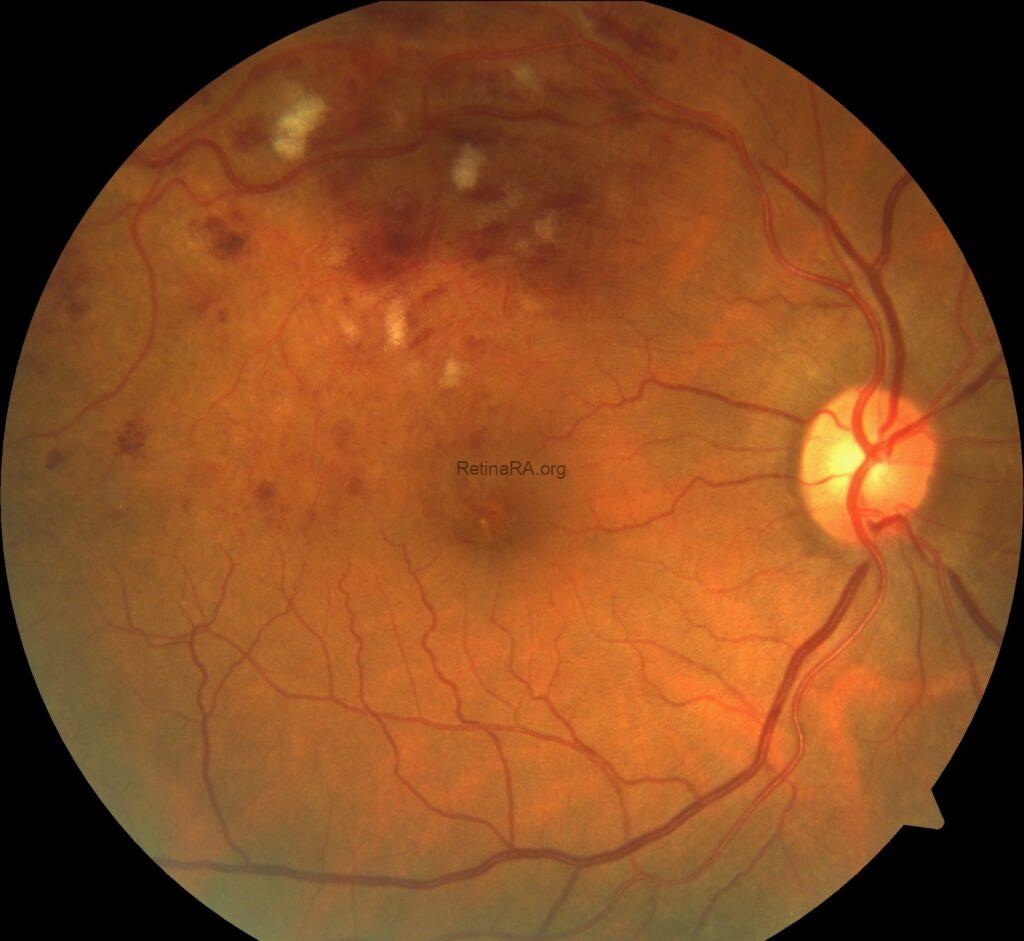 Collateral Vessels in Branch Retinal Vein Occlusion - RetinaRA