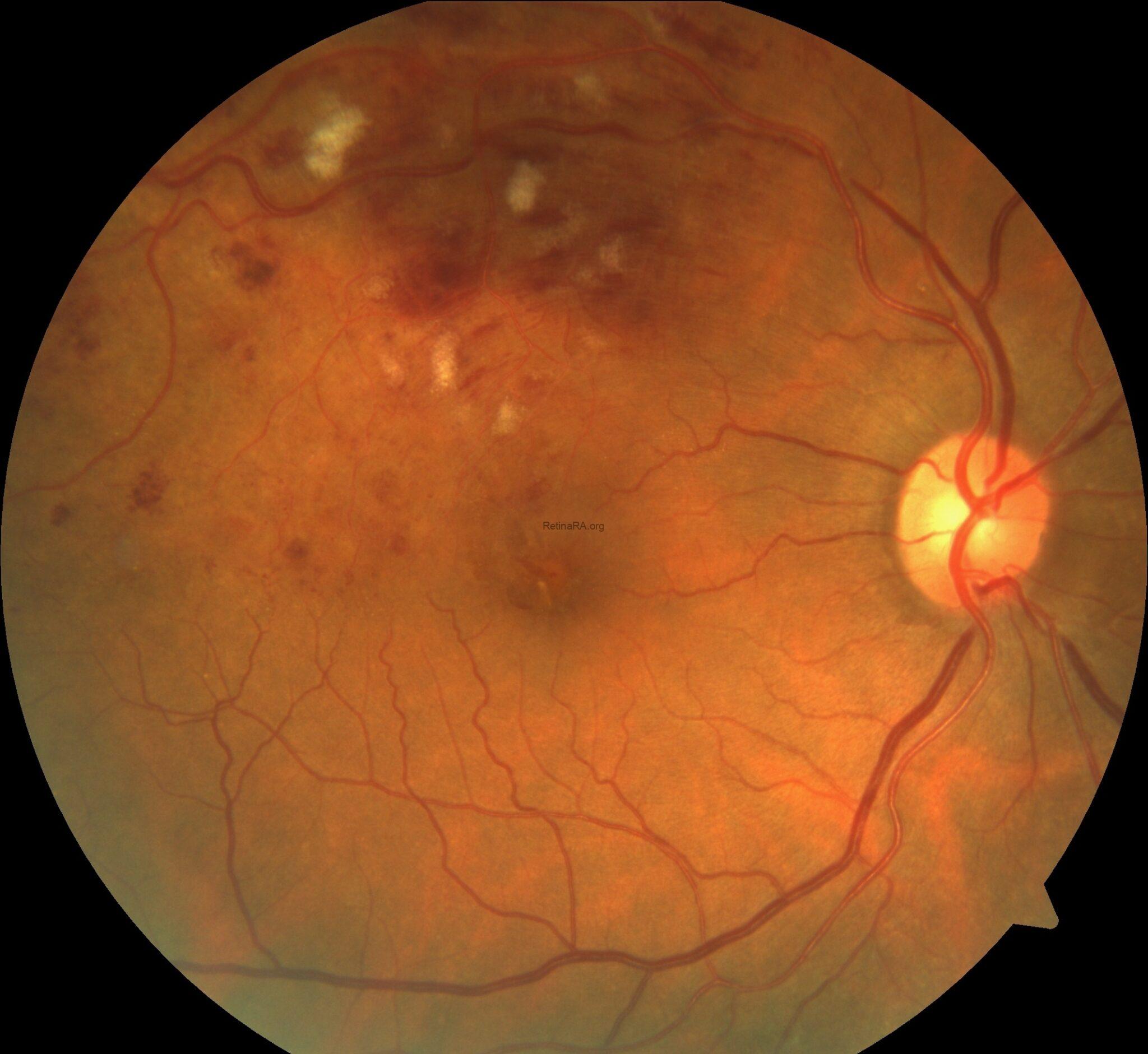 Collateral Vessels in Branch Retinal Vein Occlusion - RetinaRA
