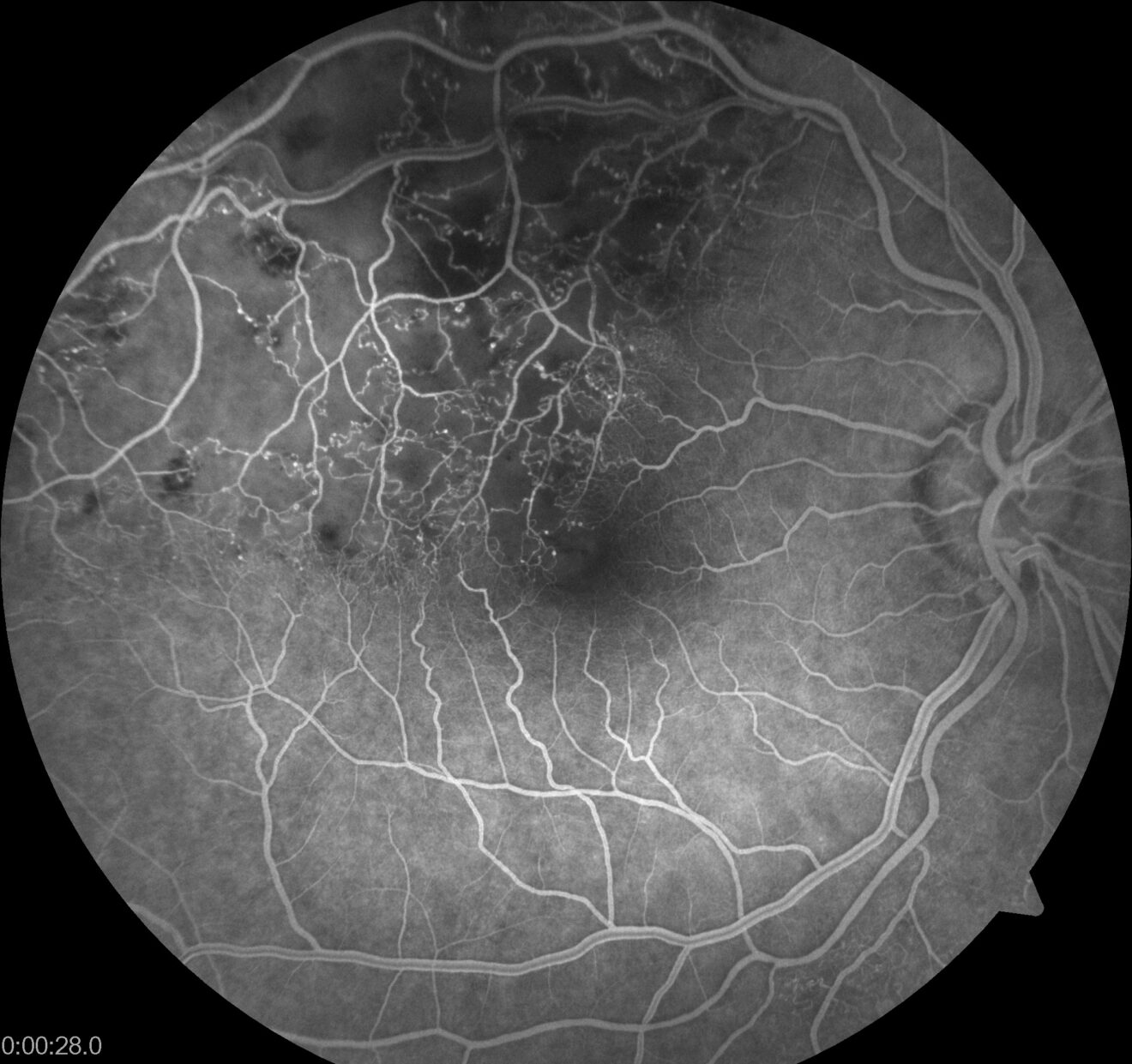 Collateral Vessels in Branch Retinal Vein Occlusion - RetinaRA