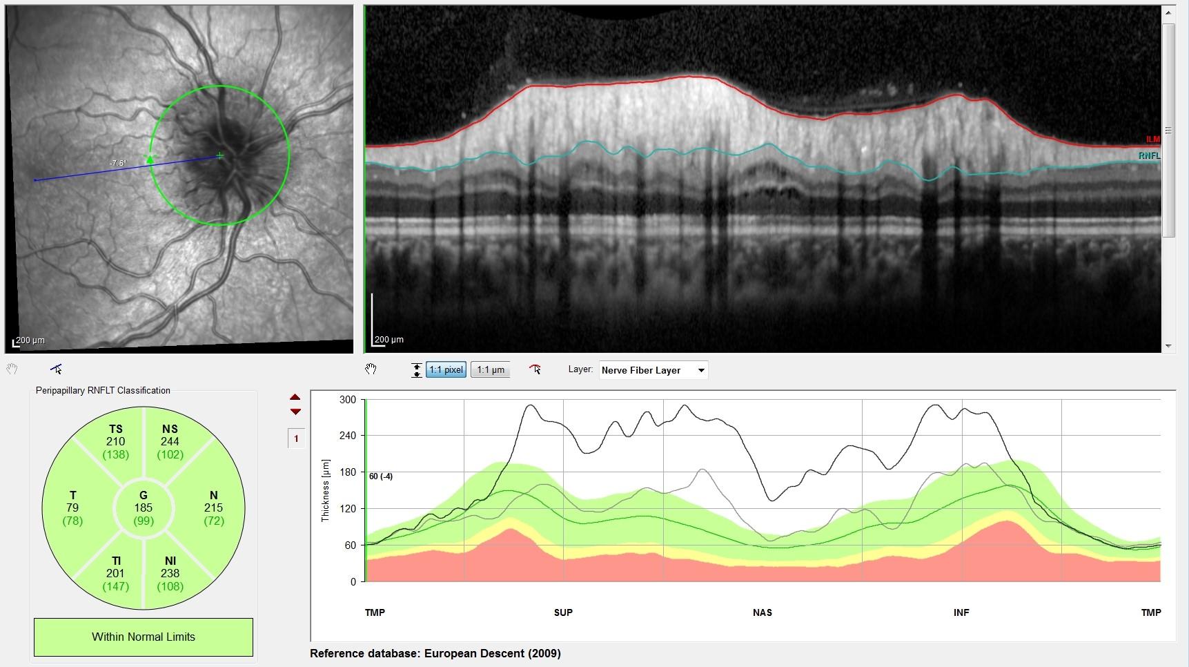 Papilledema - RetinaRA