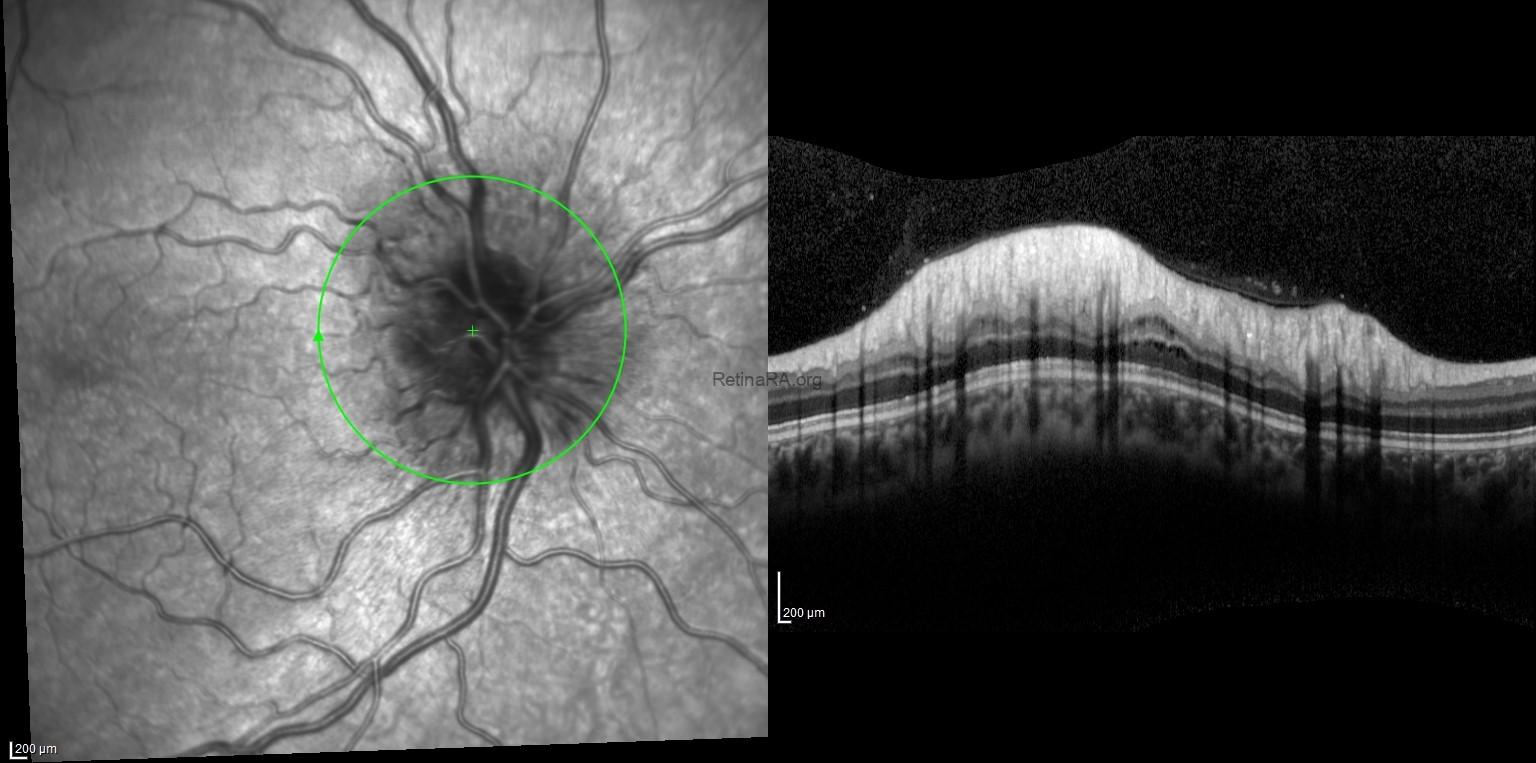 Papilledema - RetinaRA