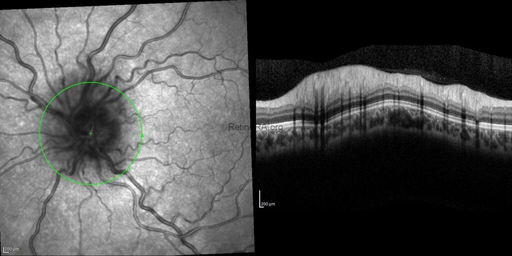 Papilledema - RetinaRA