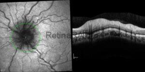 Papilledema - RetinaRA