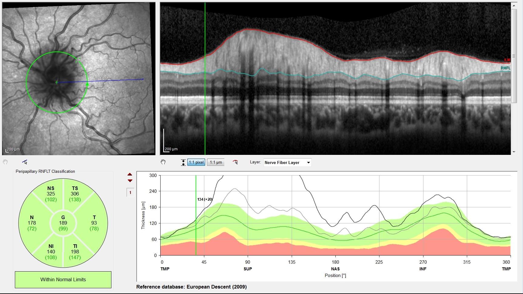 Papilledema - RetinaRA