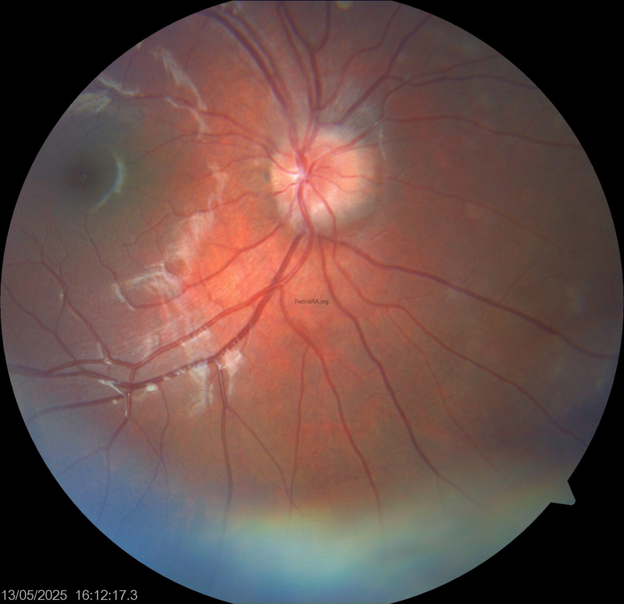 Peripapillary Hyperreflective Ovoid Mass-Like Structures (PHOMS) - RetinaRA