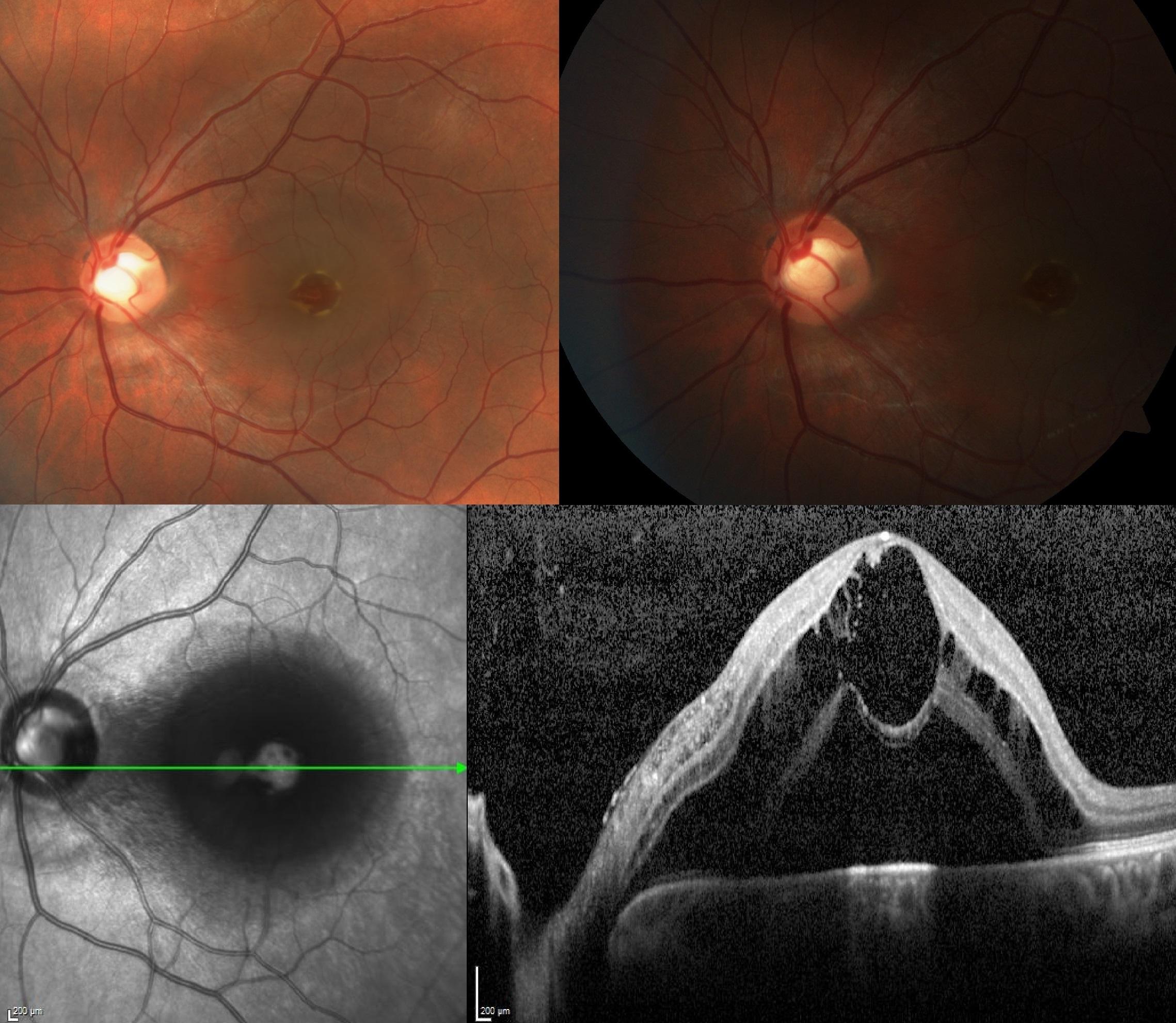 Optic Disc Pit Maculopathy - RetinaRA
