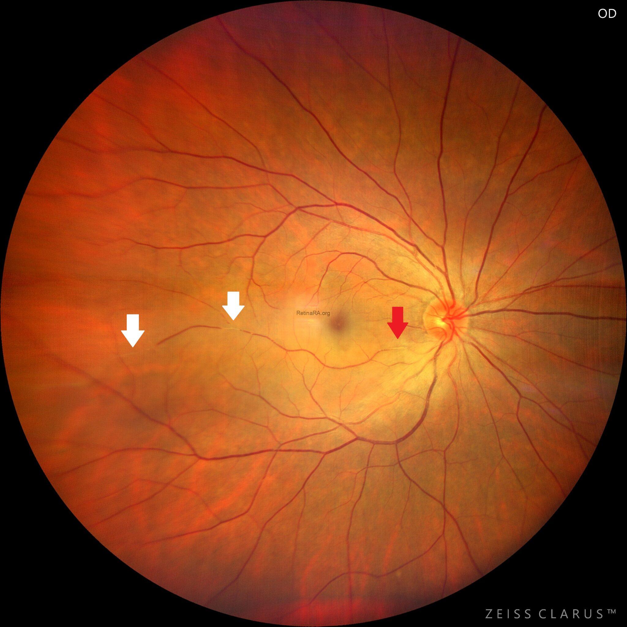 Branch Retinal Artery Occlusion - RetinaRA
