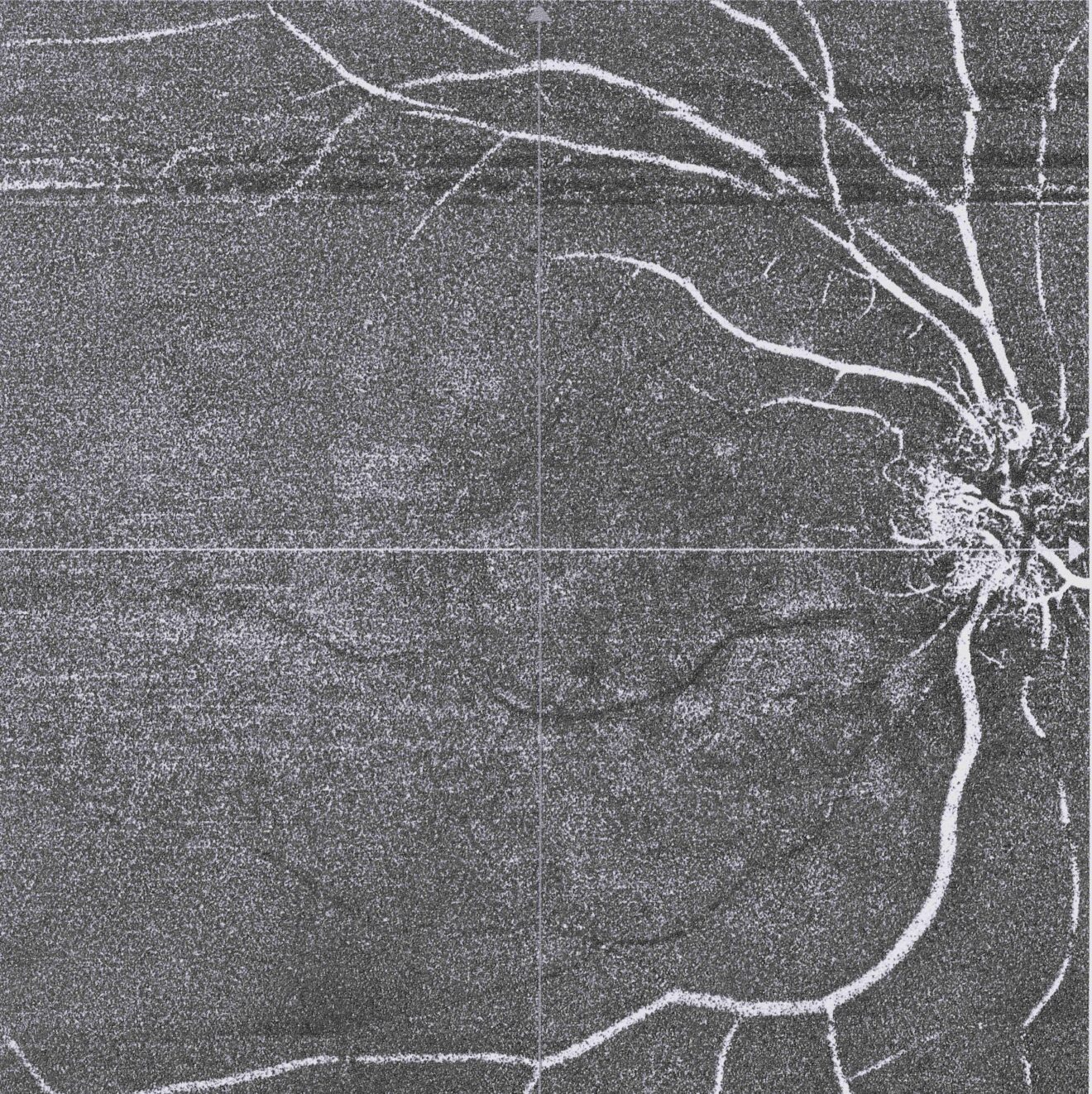 Branch Retinal Artery Occlusion - RetinaRA
