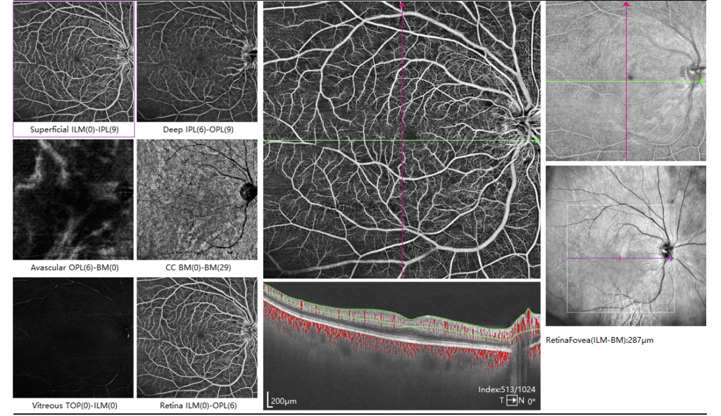 Branch Retinal Artery Occlusion - RetinaRA