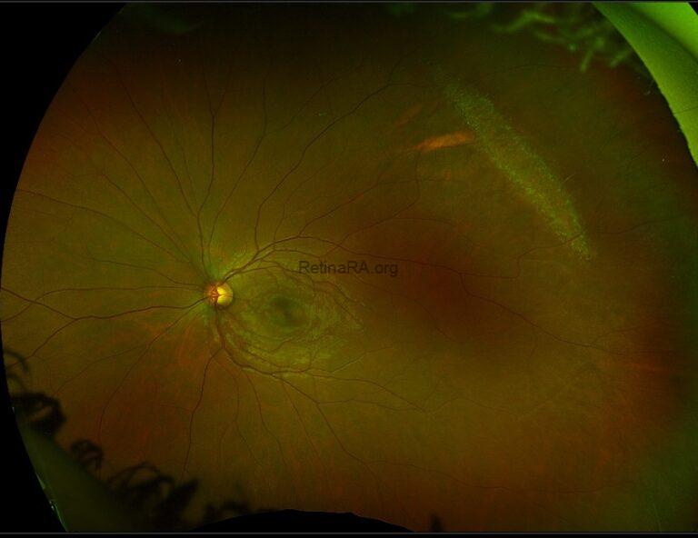 Snail-Track Degeneration - RetinaRA