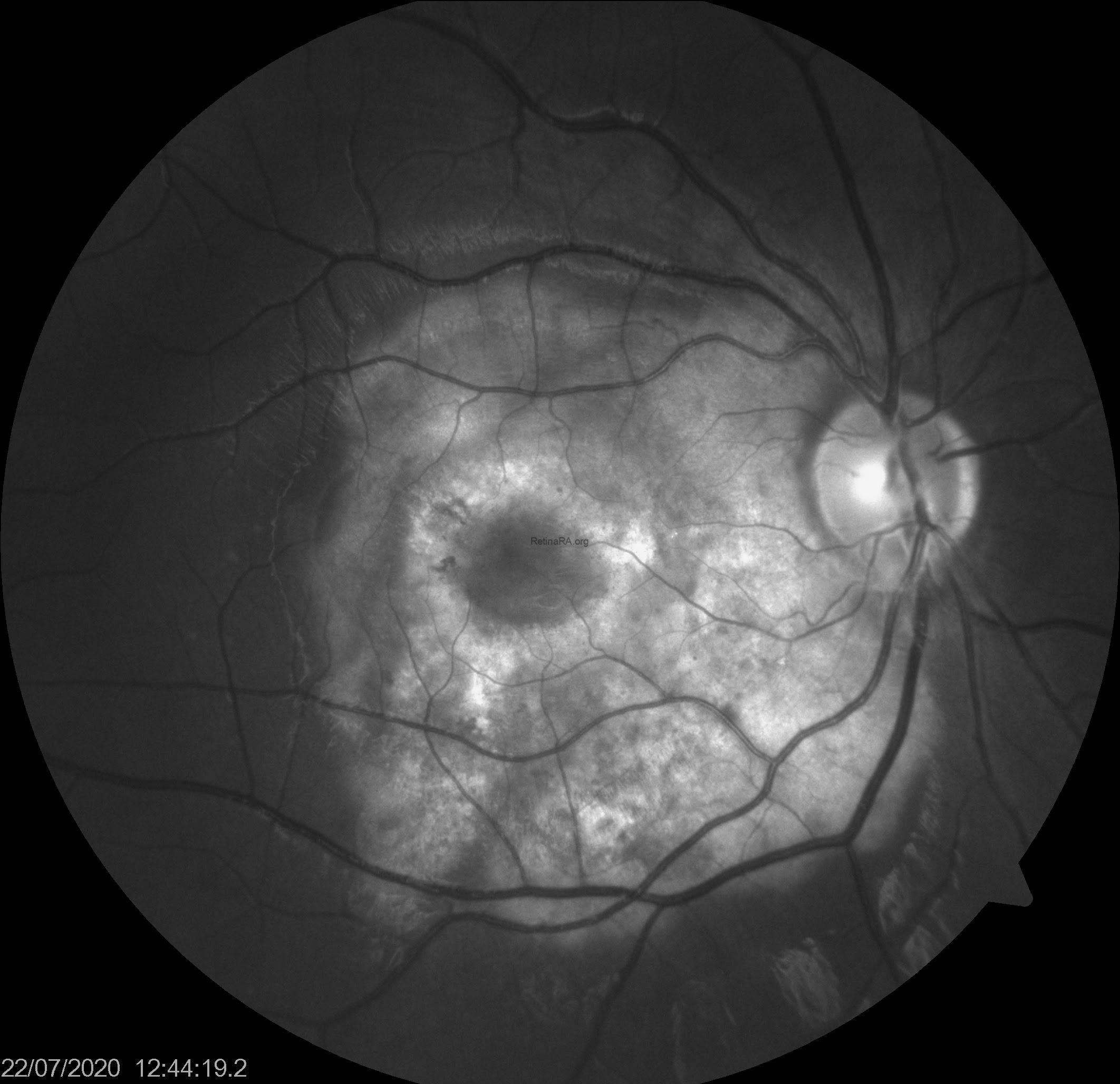 Choroidal osteoma complicated with CNVM - RetinaRA