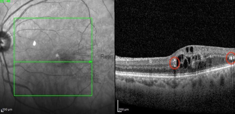 Perifoveal Exudative Vascular Anomalous Complex (PEVAC) - RetinaRA