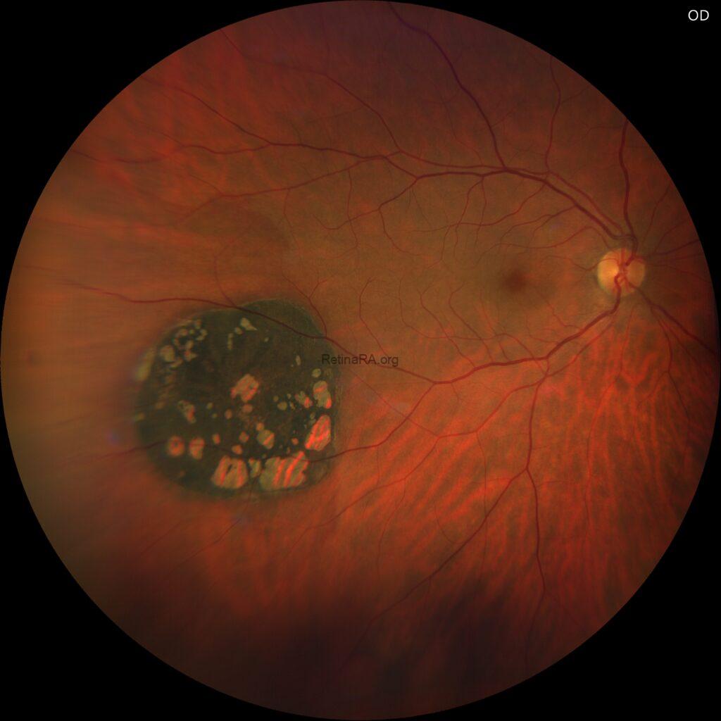 Solitary congenital hypertrophy of the retinal pigment epithelium ...