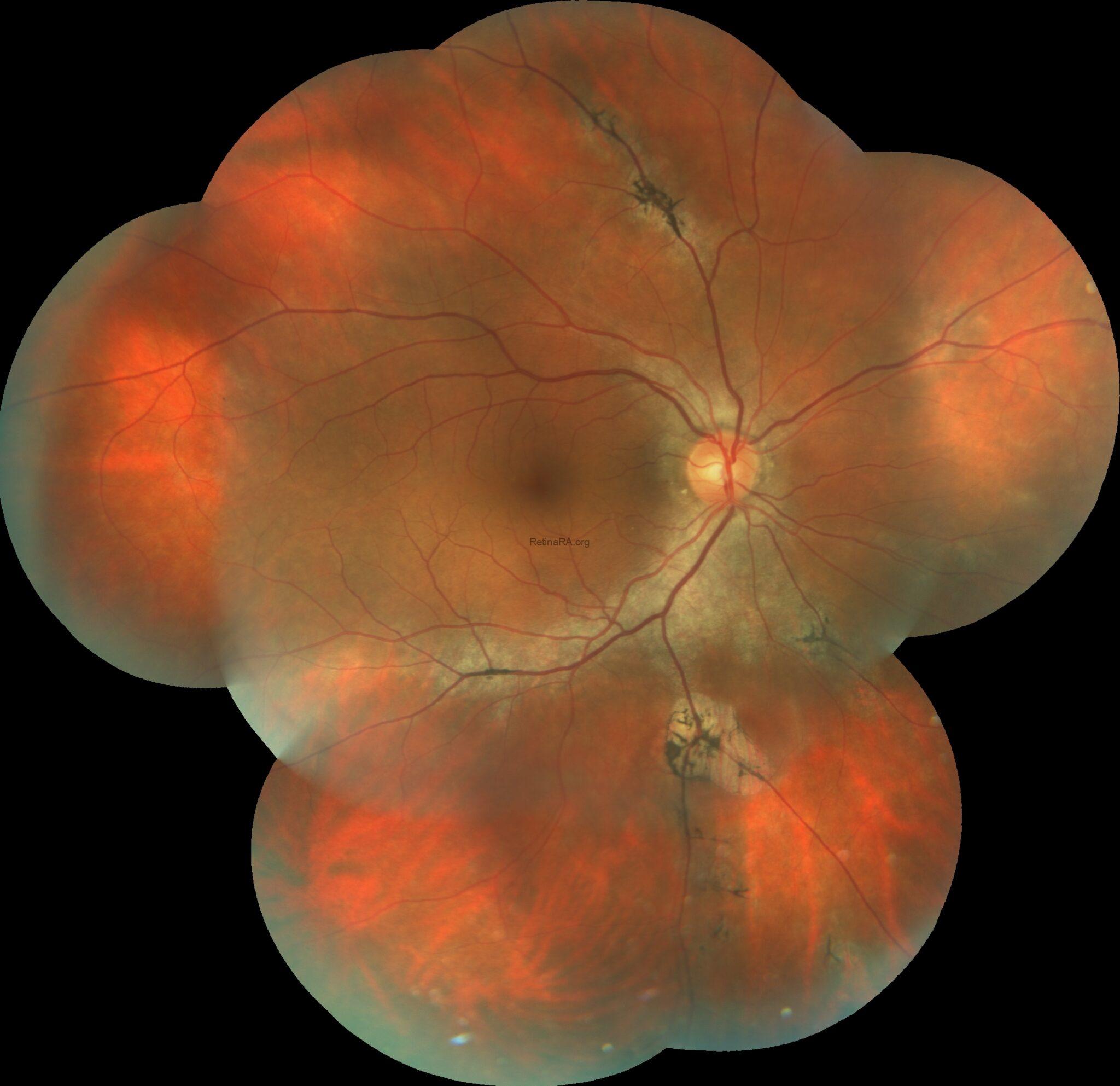 Pigmented Paravenous Retinochoroidal Atrophy: A Case of Misdiagnosed as ...