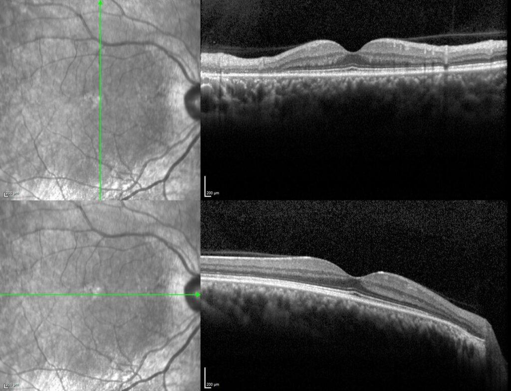 Pigmented Paravenous Retinochoroidal Atrophy: A Case of Misdiagnosed as ...