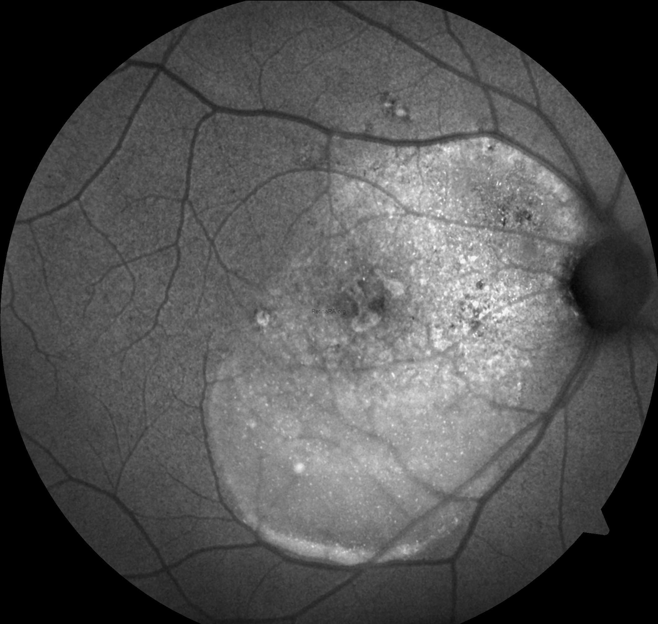 Chronic Central Serous Chorioretinopathy - RetinaRA
