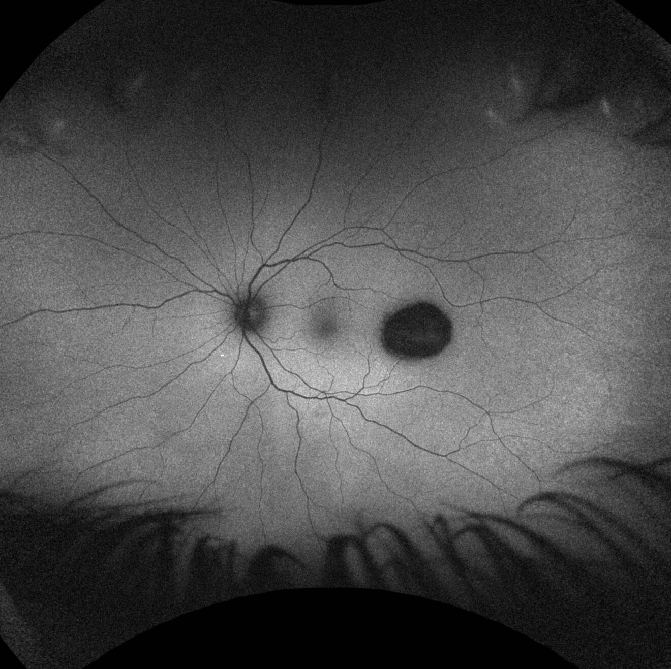 Chorioretinal Scar of Congenital Toxoplasmosis - RetinaRA