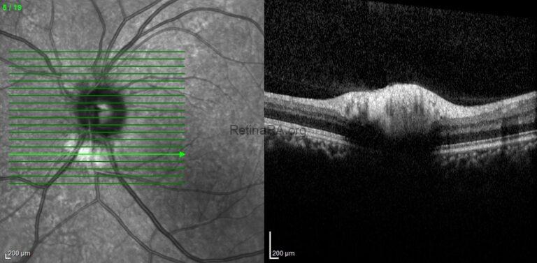 Myelinated Retinal Nerve Fiber Layer - RetinaRA